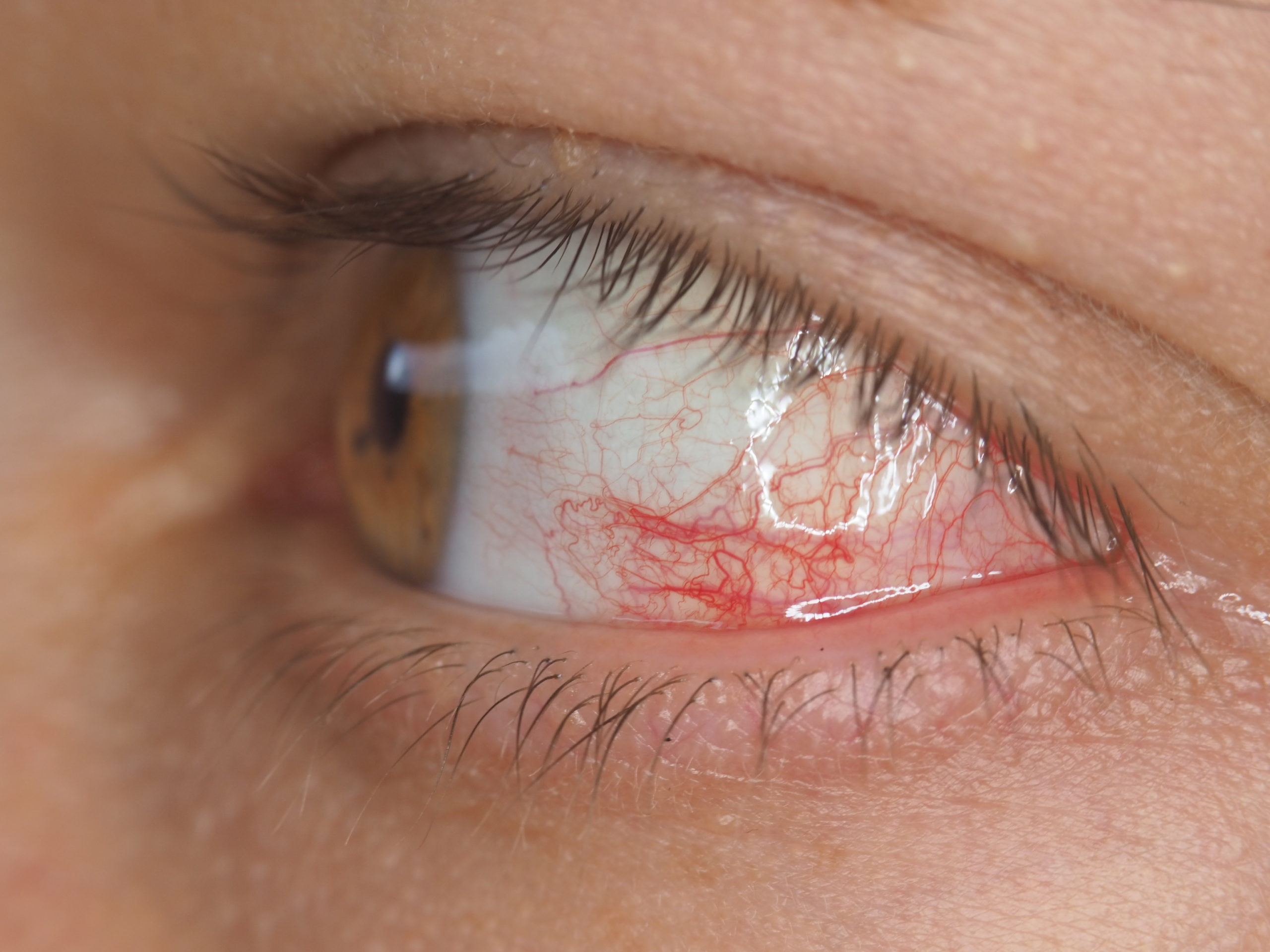 What is Pterygium or Surfer's Eye? - Dr Agarwal's Eye Hospital