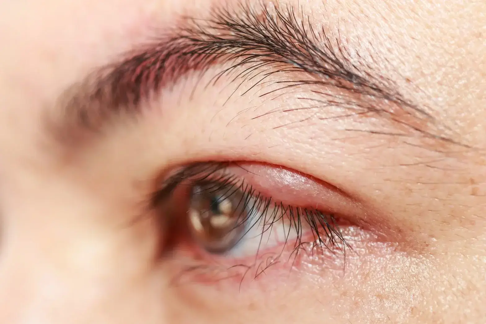Understanding and Treating Blepharitis: An In-Depth Guide to Anterior ...