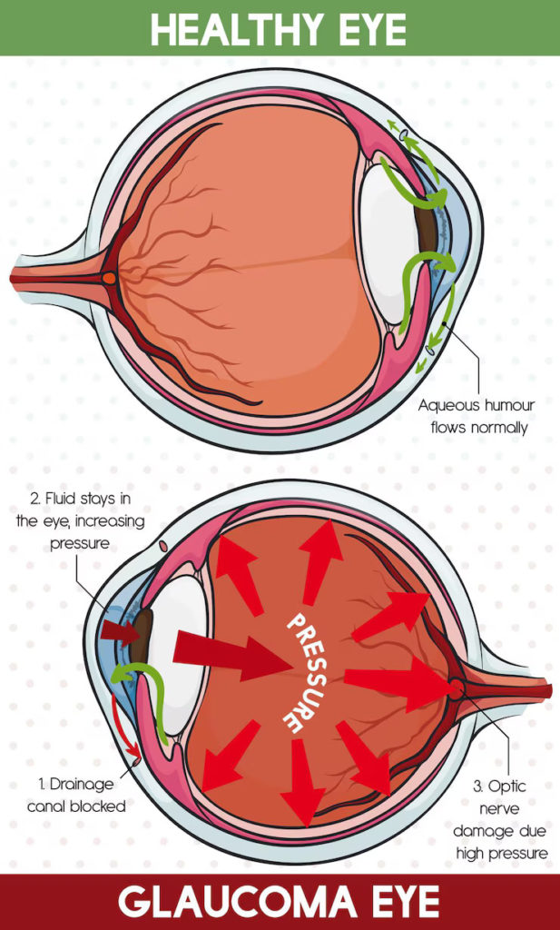 Narrow-Angle Glaucoma: Causes, Symptoms, and Treatments