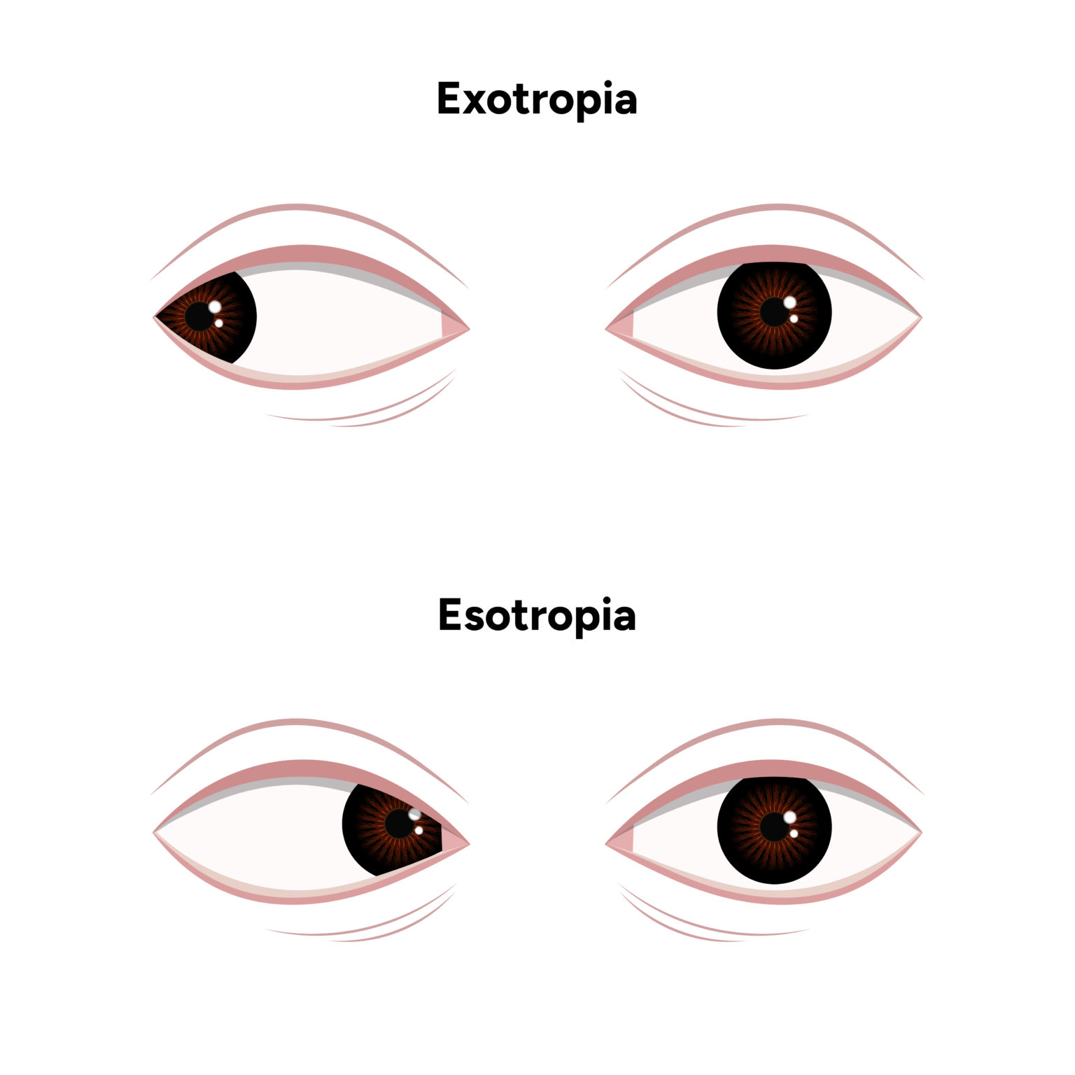 Exotropia Treatment: Meaning, Glasses and Surgery Options.