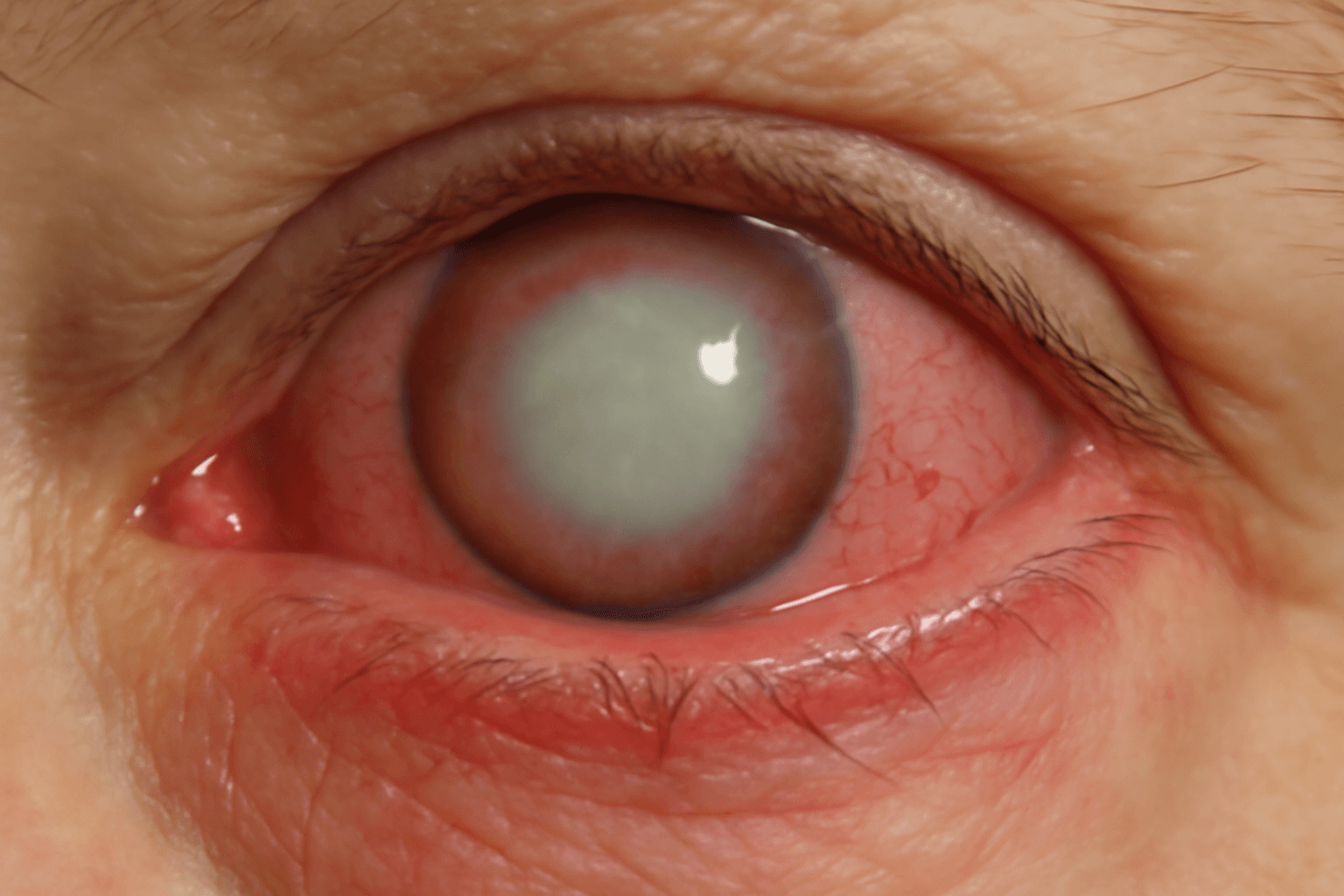 Phacomorphic Glaucoma: Causes, Symptoms, and Treatments | Dr Agarwals