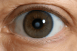 Blue Dot Cataract: Symptoms, Causes, & Treatment | Dr Agarwals