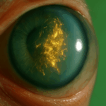 Christmas Tree Cataract: Definition, Causes, Symptoms, and Treatments ...
