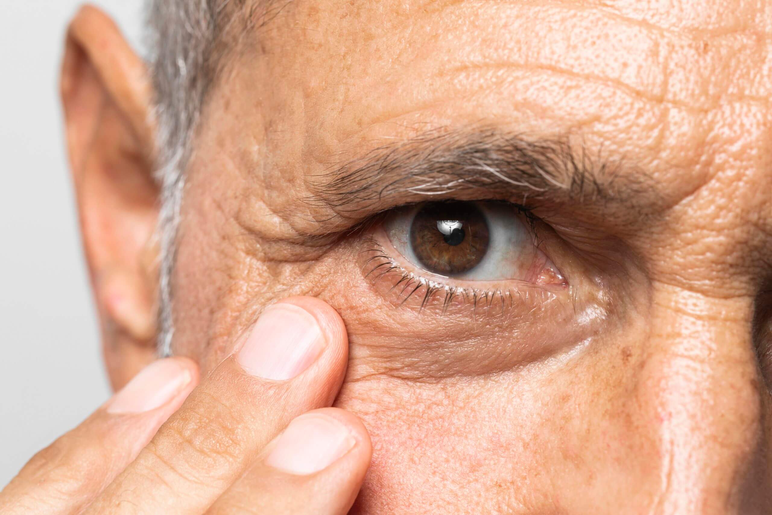 Remove Cholesterol Deposits Around Eyes Naturally