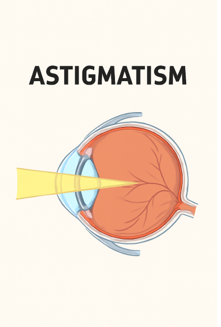 Astigmatism vs Myopia: Causes, Symptoms & Treatments