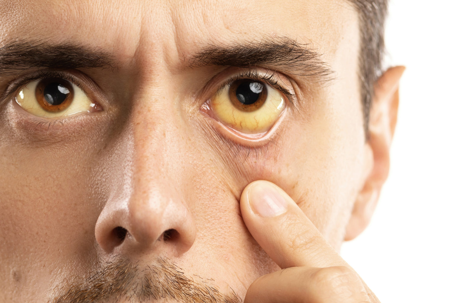 Scleral Icterus (Yellow Eyes): Causes, Symptoms & Treatment