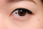Brown Spot on Eye: Causes, Symptoms, and Treatment Explained