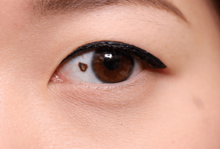 Brown Spot on Eye: Causes, Symptoms, and Treatment Explained