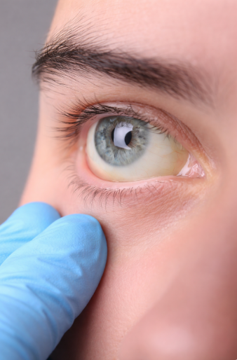 Evisceration of Eye: Procedure, Recovery & Meaning Explained