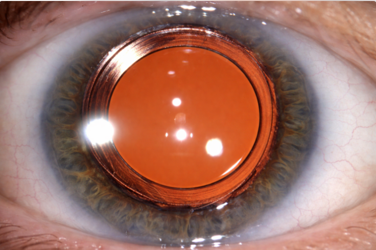 Posterior Capsular Opacification (PCO): Causes, Symptoms & Treatment