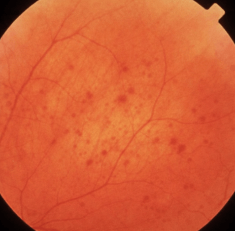 Retinal Hemorrhage Explained: Causes, Symptoms & Treatments