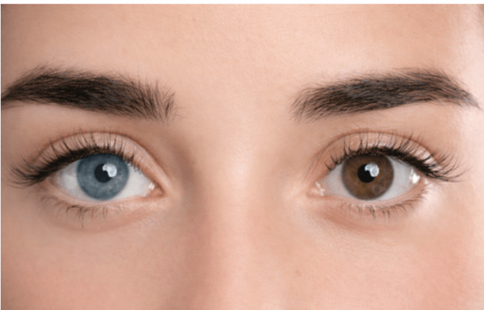 Understanding Heterochromia: A Guide to Different Colored Eyes
