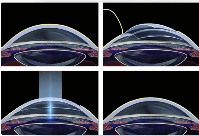 What Is Epi LASIK? Safe Vision Correction for Thin Corneas