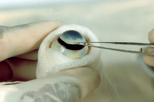 What Is an Eye Bank? Role of Eye Bankers & Eye Banking Explained